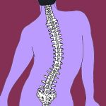 Dextroscoliosis - Scoliosis